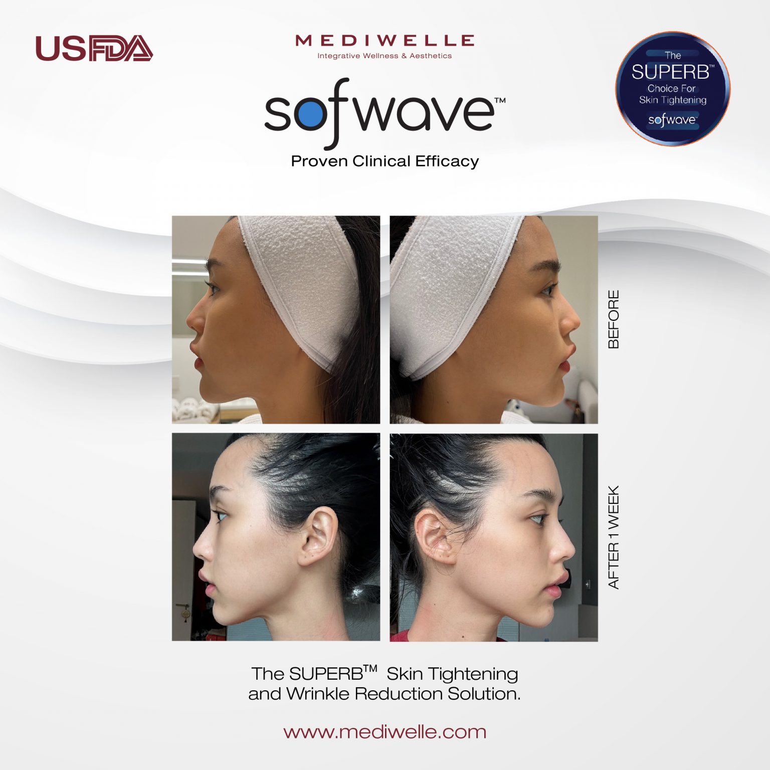 Sofwave นวัตกรรมยกกระชับใบหน้า โดยไม่ต้องผ่าตัด - Mediwelle